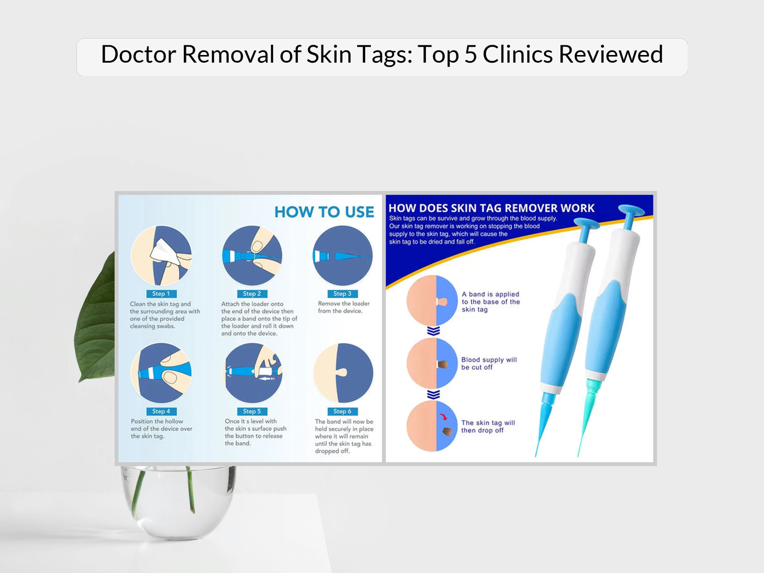 Doctor Removal of Skin Tags: Top 5 Clinics Reviewed – KentDO™ Healthy ...