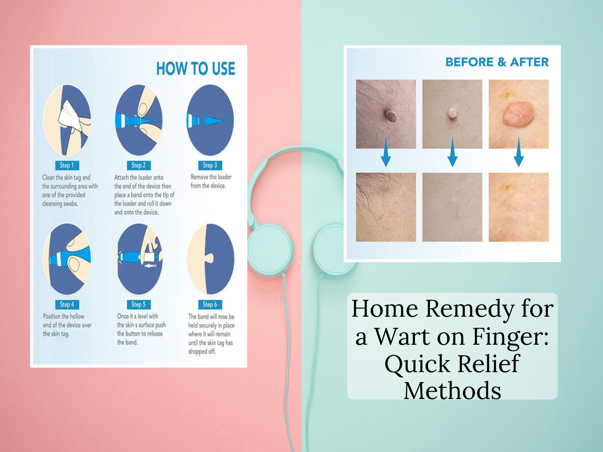 Home Remedy for a Wart on Finger: Quick Relief Methods – KentDO™ Healthy & Beauty
