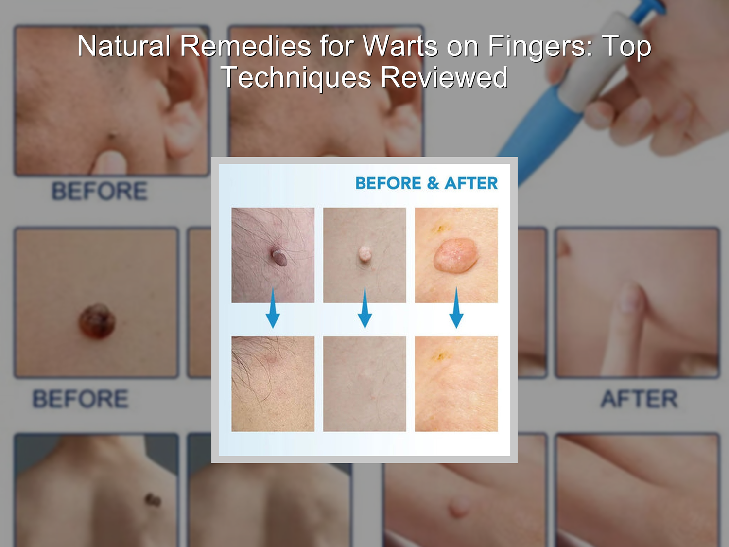 Natural Remedies for Warts on Fingers: Top Techniques Reviewed – KentDO ...