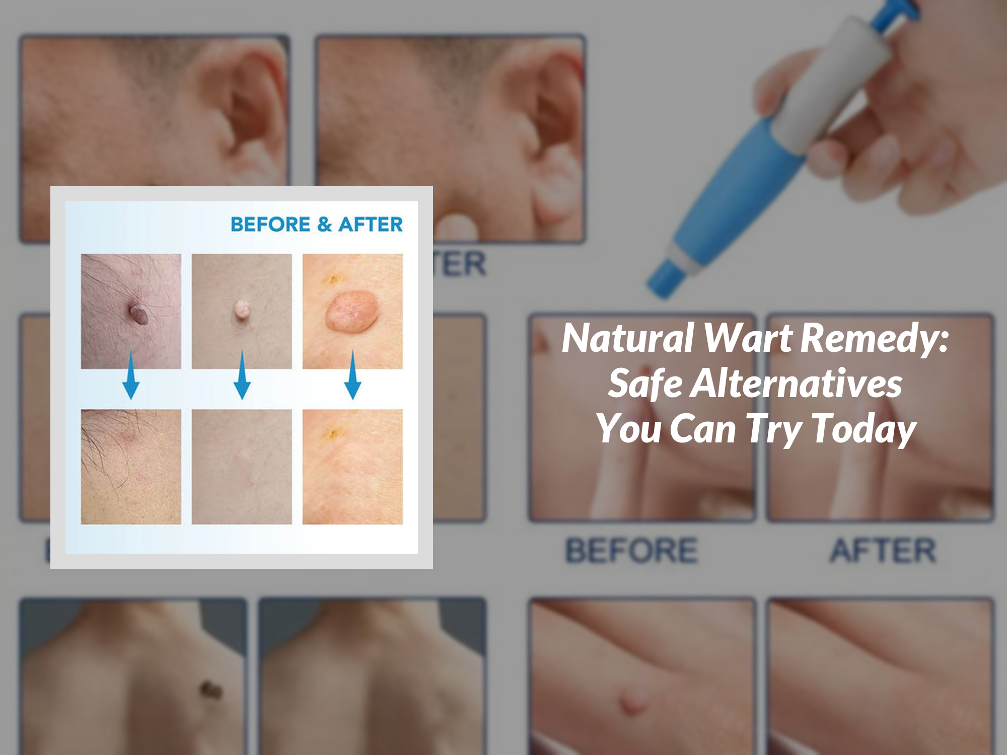 Natural Remedies for Warts: Safe Home Treatments – KentDO™ Healthy & Beauty